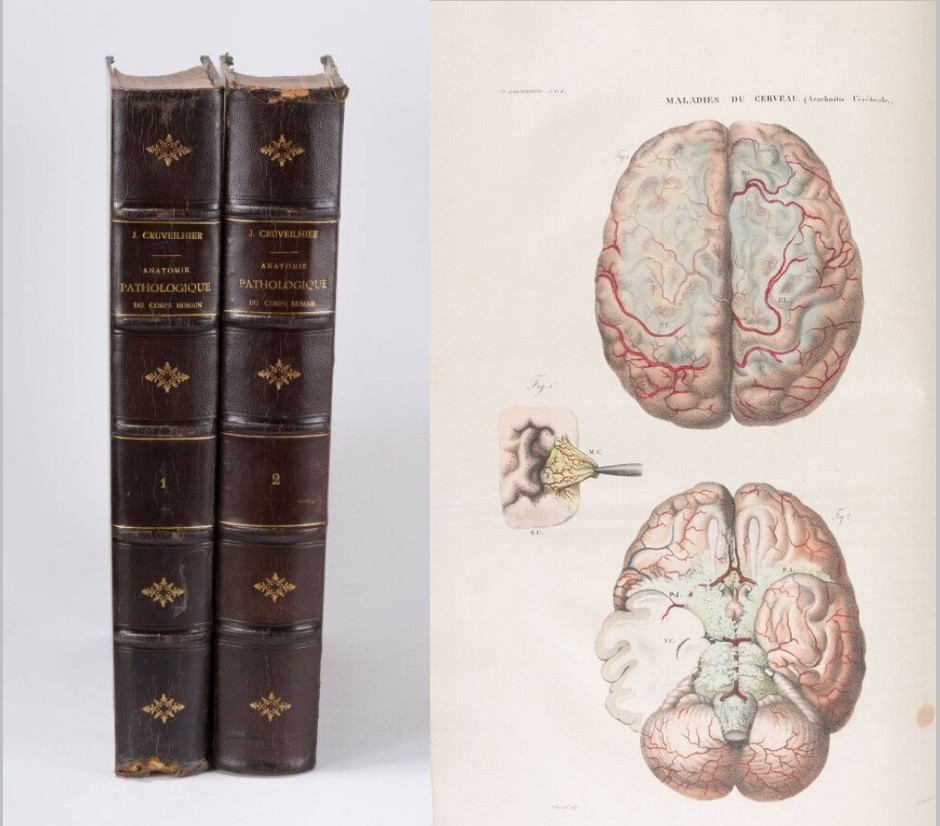 Anatomie pathologique du corps humain - Jean Cruveilhier